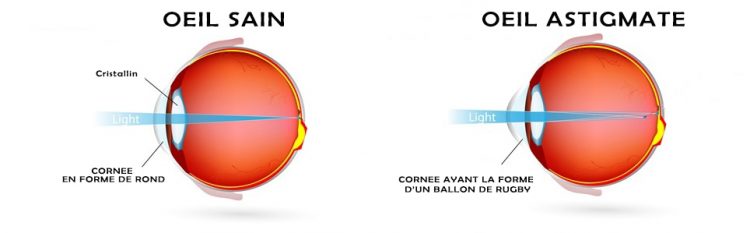 Astigmatisme - LuxOptica